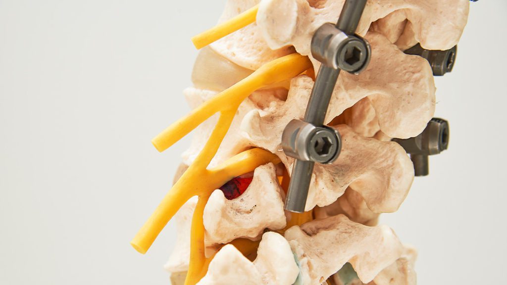 Lumbar Surgery | Methodist McKinney Hospital